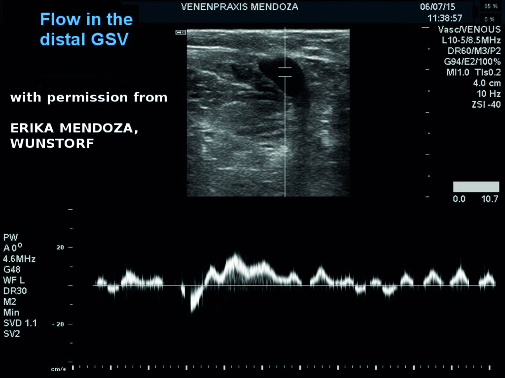 Saphenous pulsation on duplex ultrasound is a marker of severe chronic ...