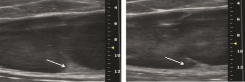 Ultrasound proof of pre-reflux stages of venous insufficiency - Venous News