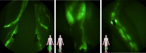 Lymphatic abnormalities and dysfunction in peripheral & venous diseases