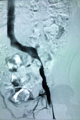 Four-month follow-up for first procedures using blueflow Venous Stent ...