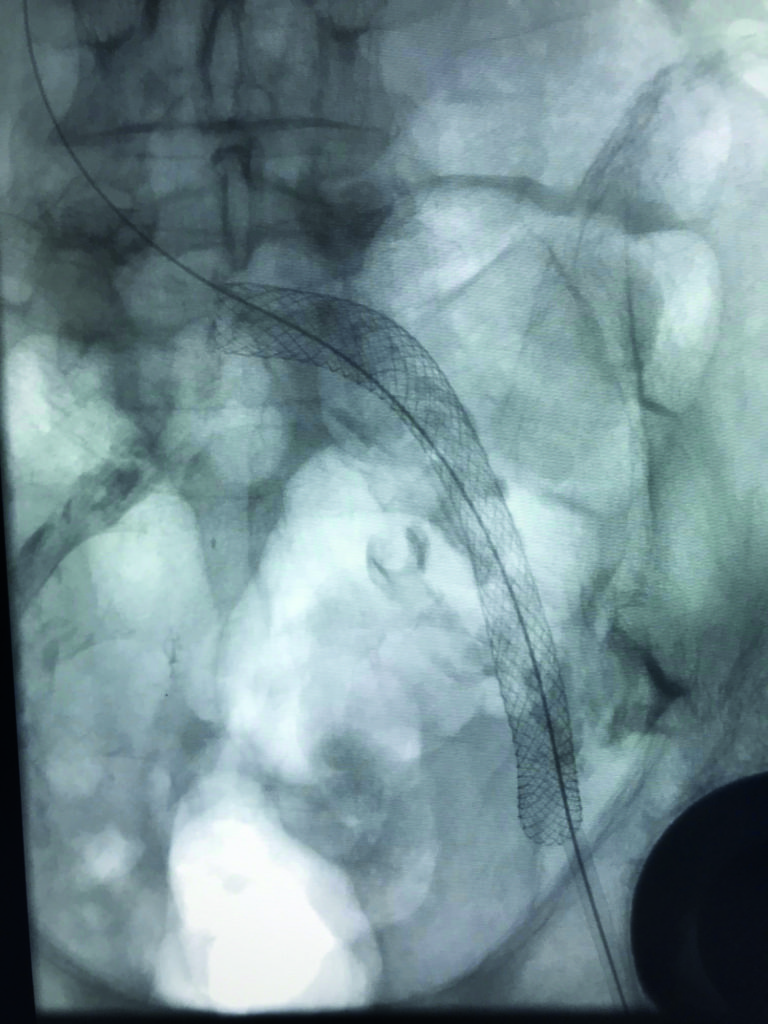 Four-month follow-up for first procedures using blueflow Venous Stent ...