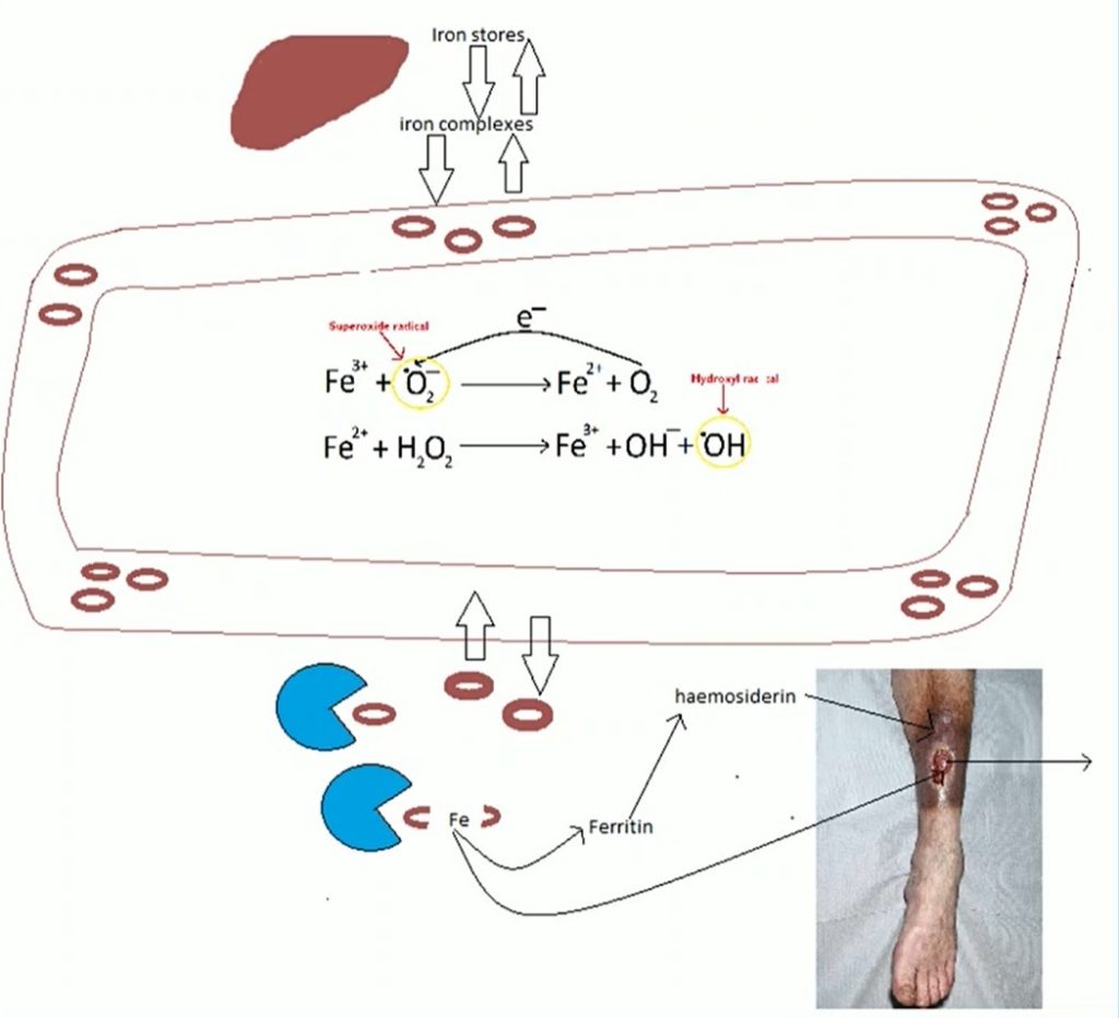 Iron loss through wound fluid may be "pathological contributor” to anaemia