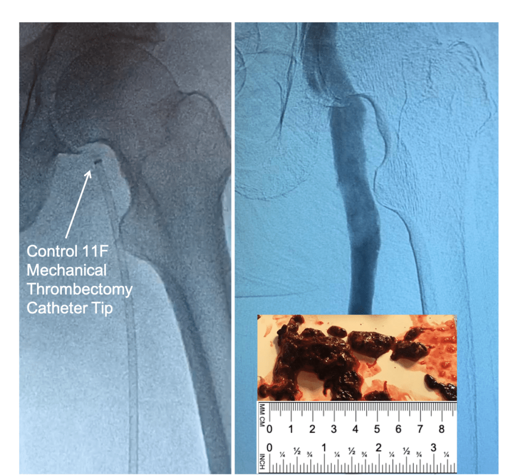 New medical device removes large blood clots in DVT patients