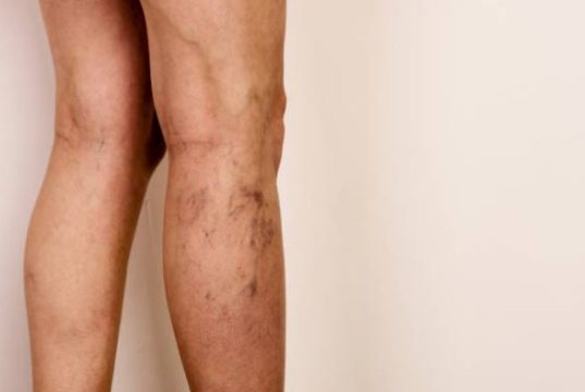 Meta-analysis of PTS finds one in five risk of long-term symptoms ...
