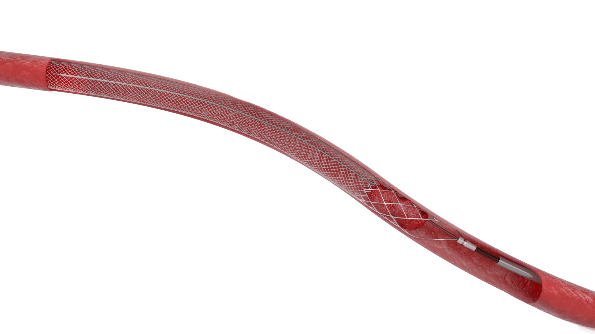 ClotTriever-device.png - Venous News
