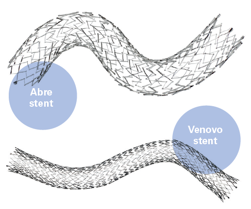 Nitinol stents placed in iliac veins “not associated with prolonged ...