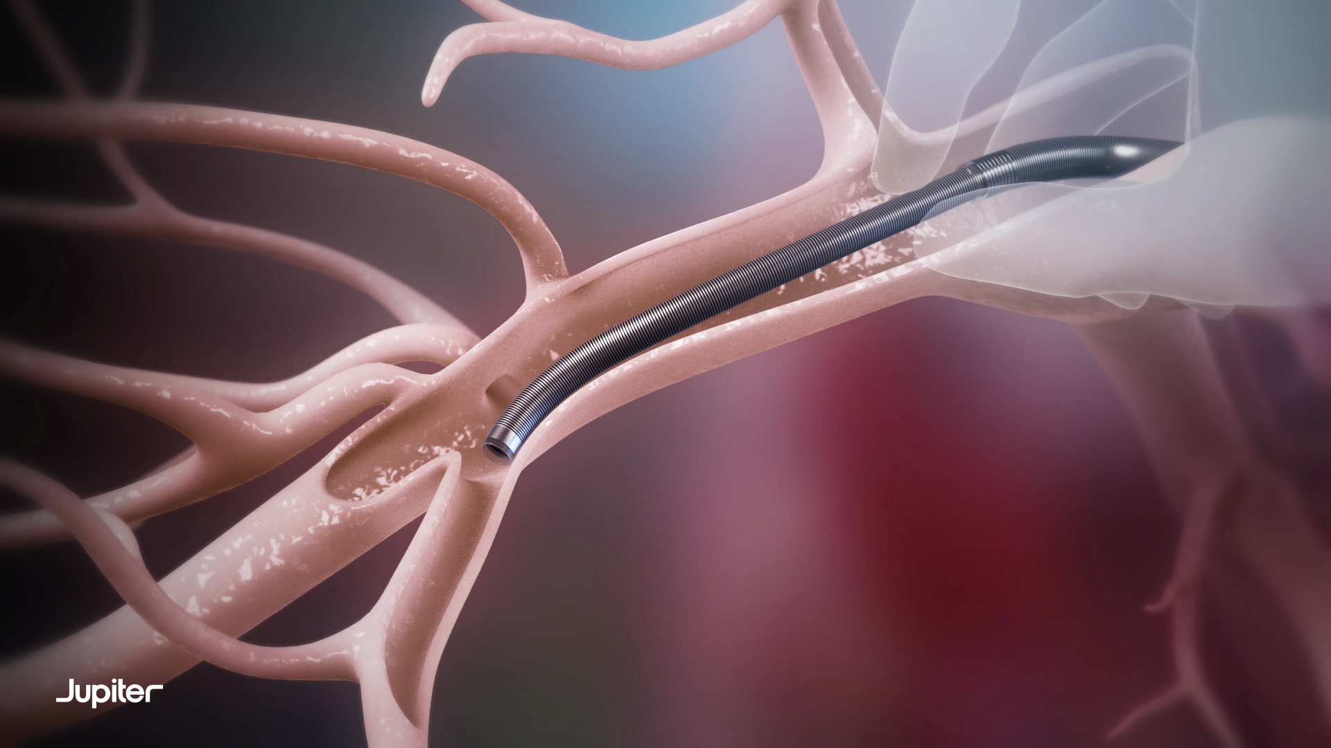 Jupiter Endovascular announces US FDA approval for SPIRARE II pivotal ...