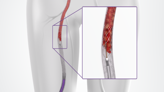 Mechanical thrombectomy shifts the needle toward interventional ...