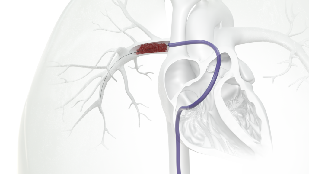 Mechanical thrombectomy shifts the needle toward interventional ...