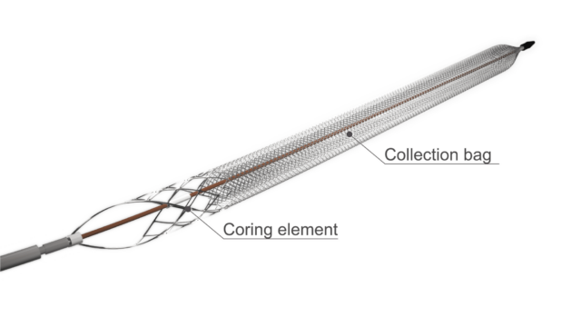 Inari Medical’s ClotTriever thrombectomy system gains reimbursement ...